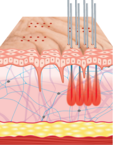 Pixel8-RF | Microneedling for Skin Tightening
