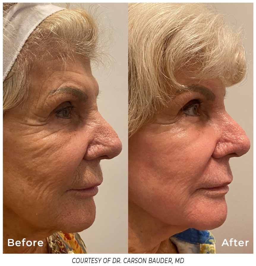 Phoenix Before and Afters - Rohrer Aesthetics