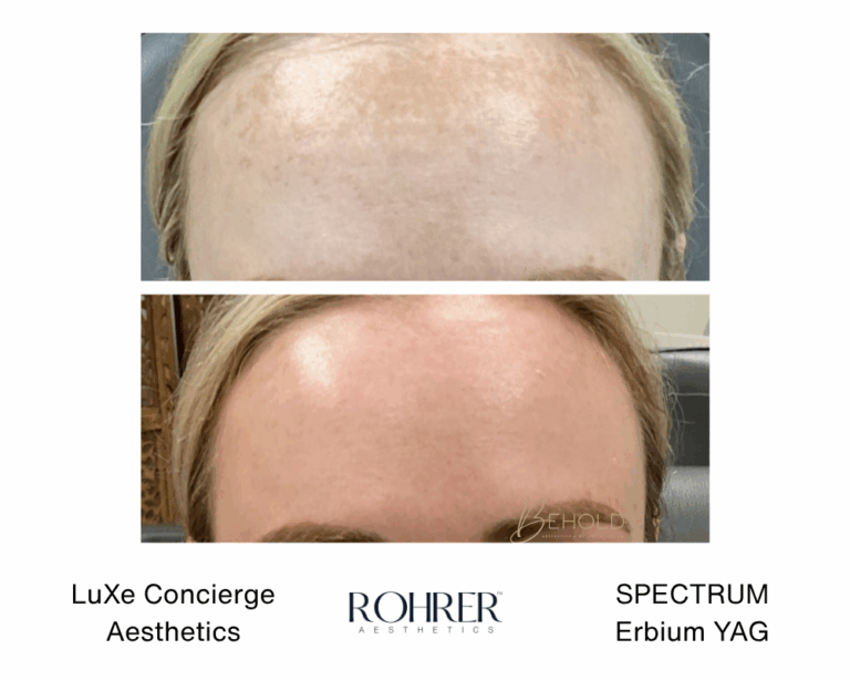 Spectrum Before and Afters - Rohrer Aesthetics